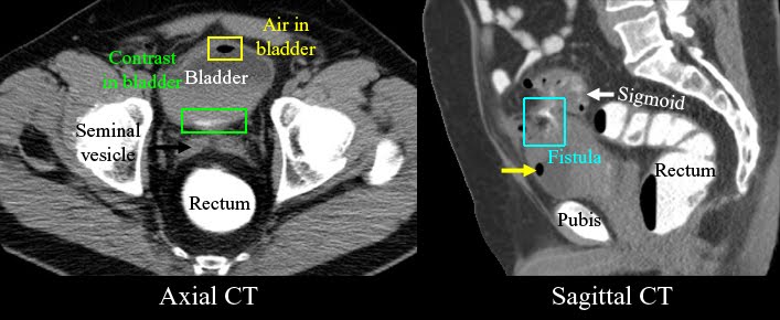 Radiologyspirit Diverticulitis Of The Sigmoid Colon With Colovesical Fistula On Ct Scans
